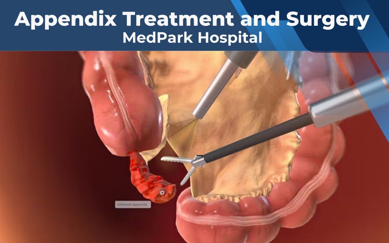 Appendix Surgery in Mohali | Expert Appendix Treatment